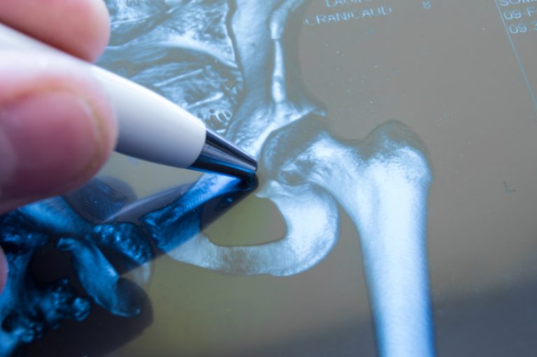 Hip Injection | Northampton Hip and Knee Clinic